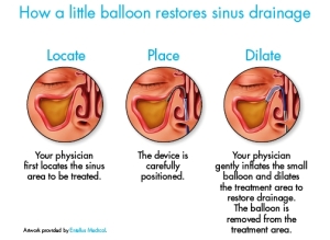 Balloon Sinus Dilation | Arkansas Center for Ear Nose Nose Throat ...