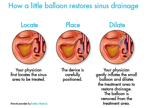 Balloon Sinus Dilation Arkansas Center For Ear Nose Nose Throat Allergy And Hearing